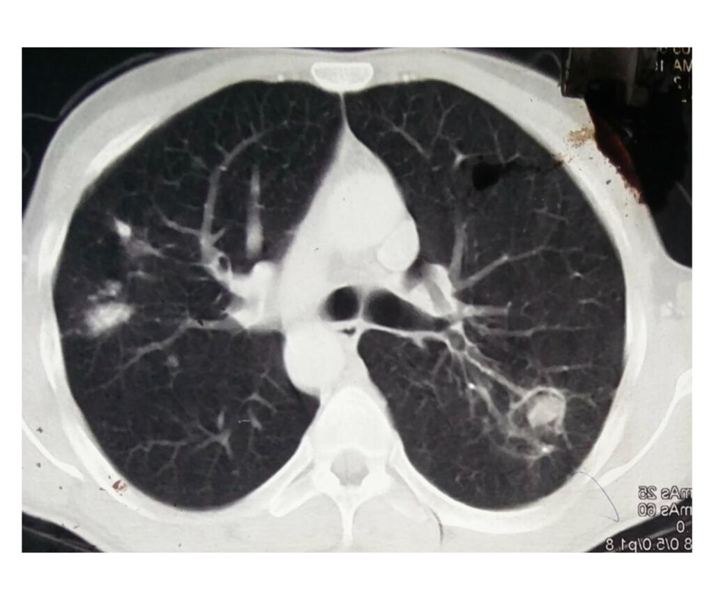 Post-Tuberculosis | TB Treatment at Holy Family Hospital Delhi