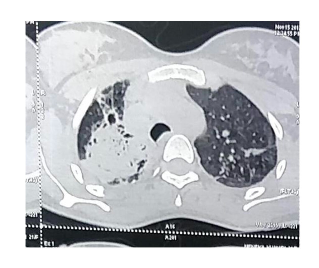 Post-Tuberculosis | TB Treatment at Holy Family Hospital Delhi