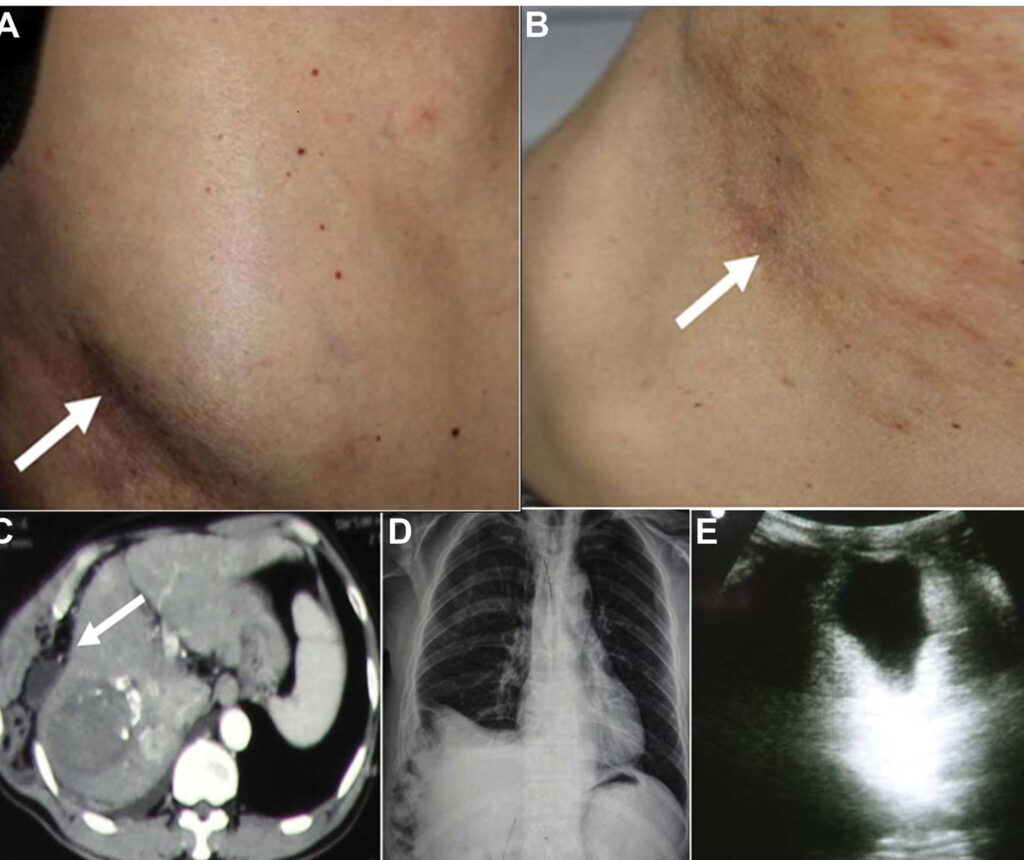 Chest Wall Tumour Surgery | Best Surgical Treatment in Delhi India