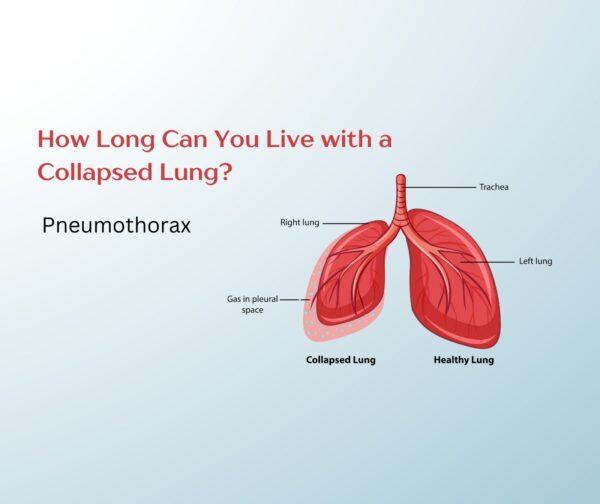 How Long Can You Live with a Collapsed Lung?